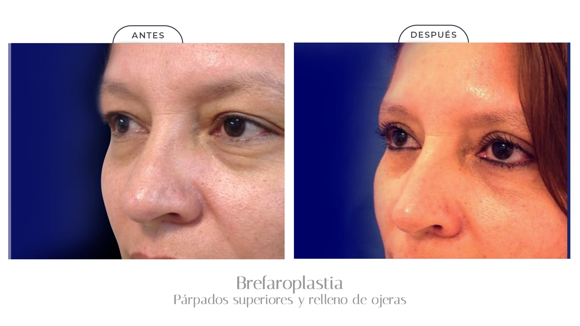 Blefaroplastia - Alamo Cirugía Plástica