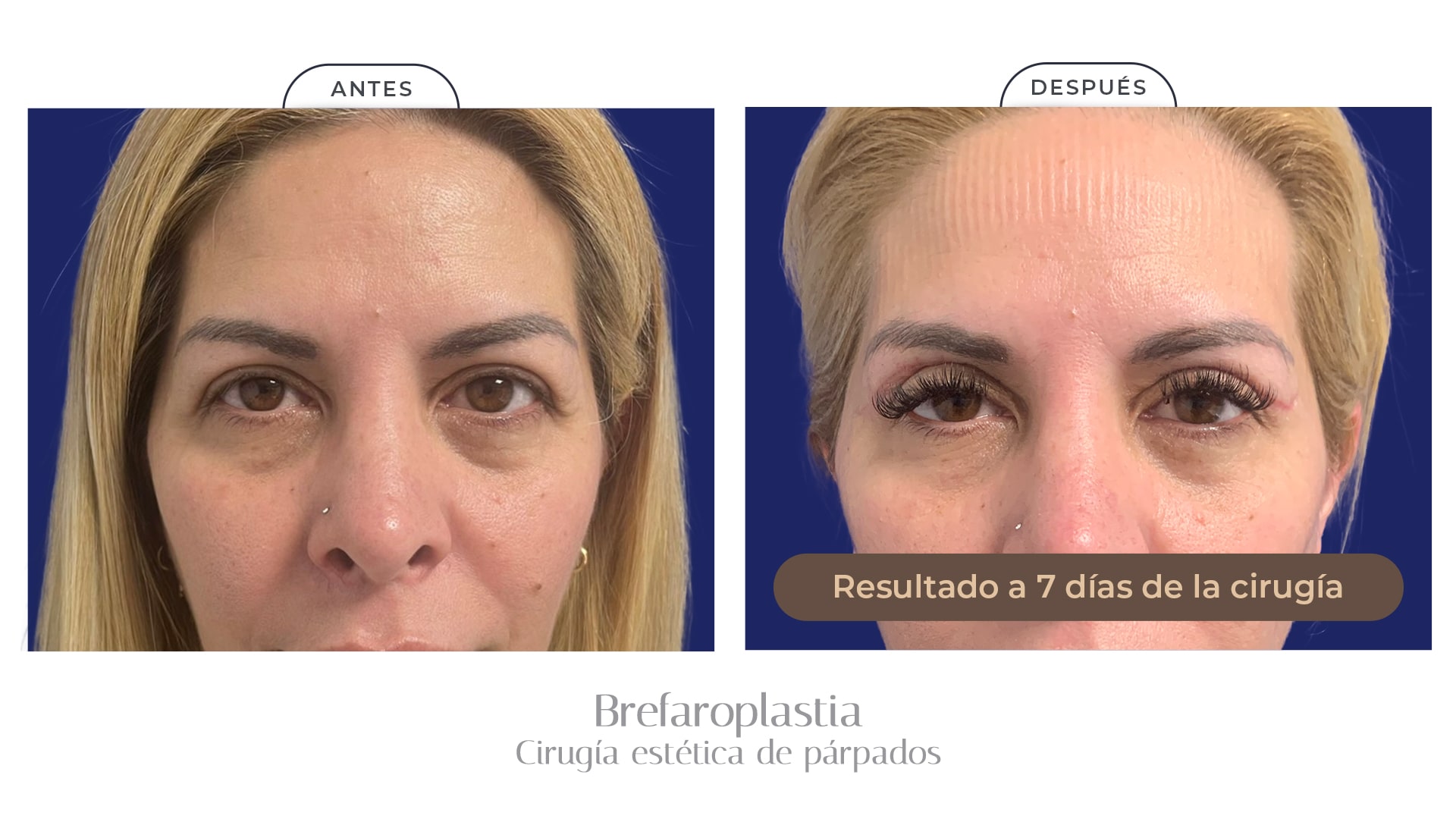 Blefaroplastia - Alamo Cirugía Plástica