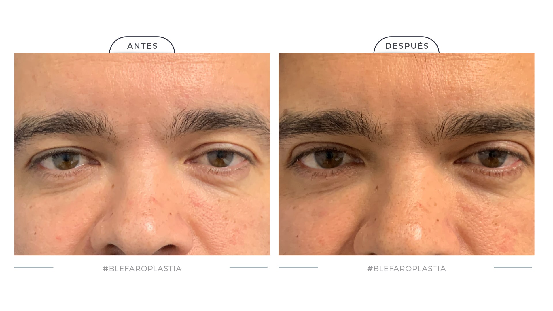 Blefaroplastia - Alamo Cirugía Plástica